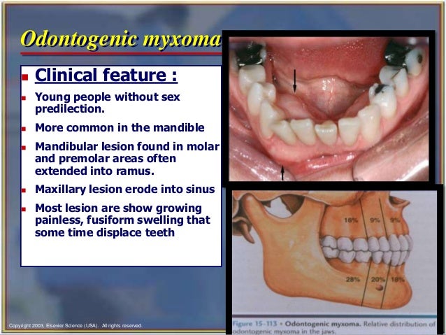 Odontogenic Tumor