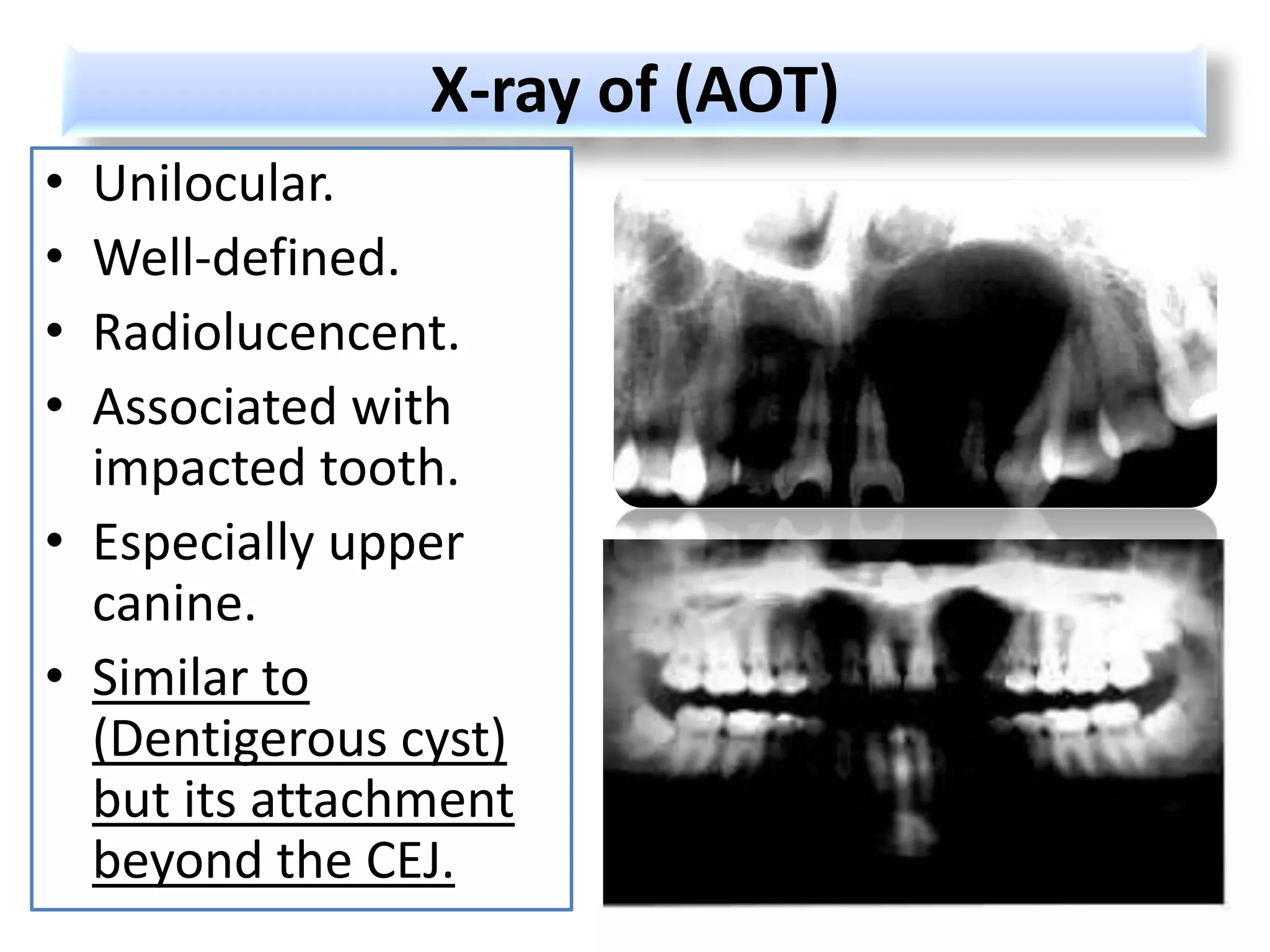 Odontogenic tumors | PPTX