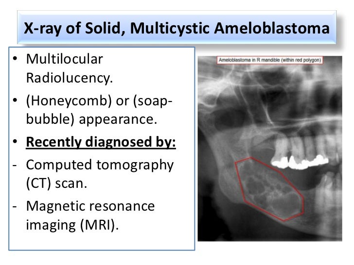 Odontogenic tumors
