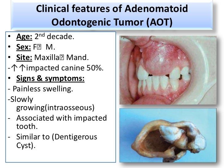 Odontogenic tumors