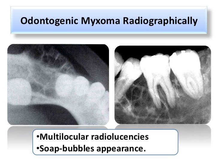 Odontogenic Tumors