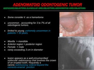Squamous Odontogenic Tumor
