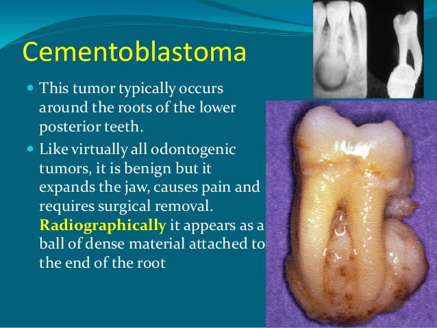 Odontogenic tumors II