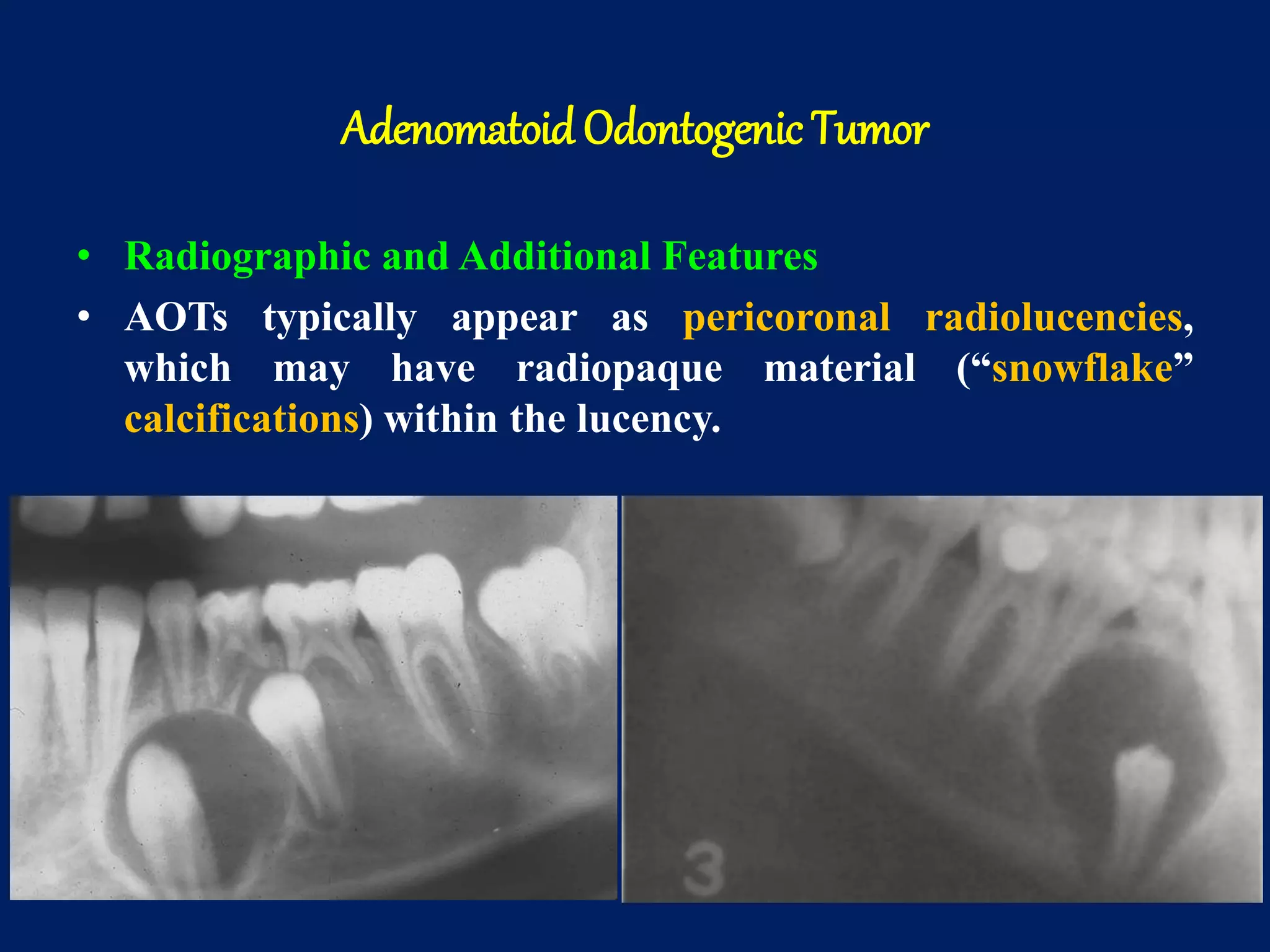 Odontogenic tumors ppt | PPTX