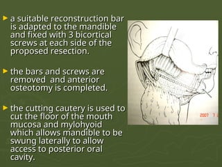 ODONTOGENIC TUMORS OF ORAL CAVITY.pptxxx | PPT
