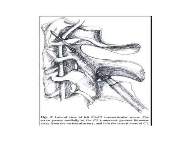 Odontoid and hangman fracture | PPTX