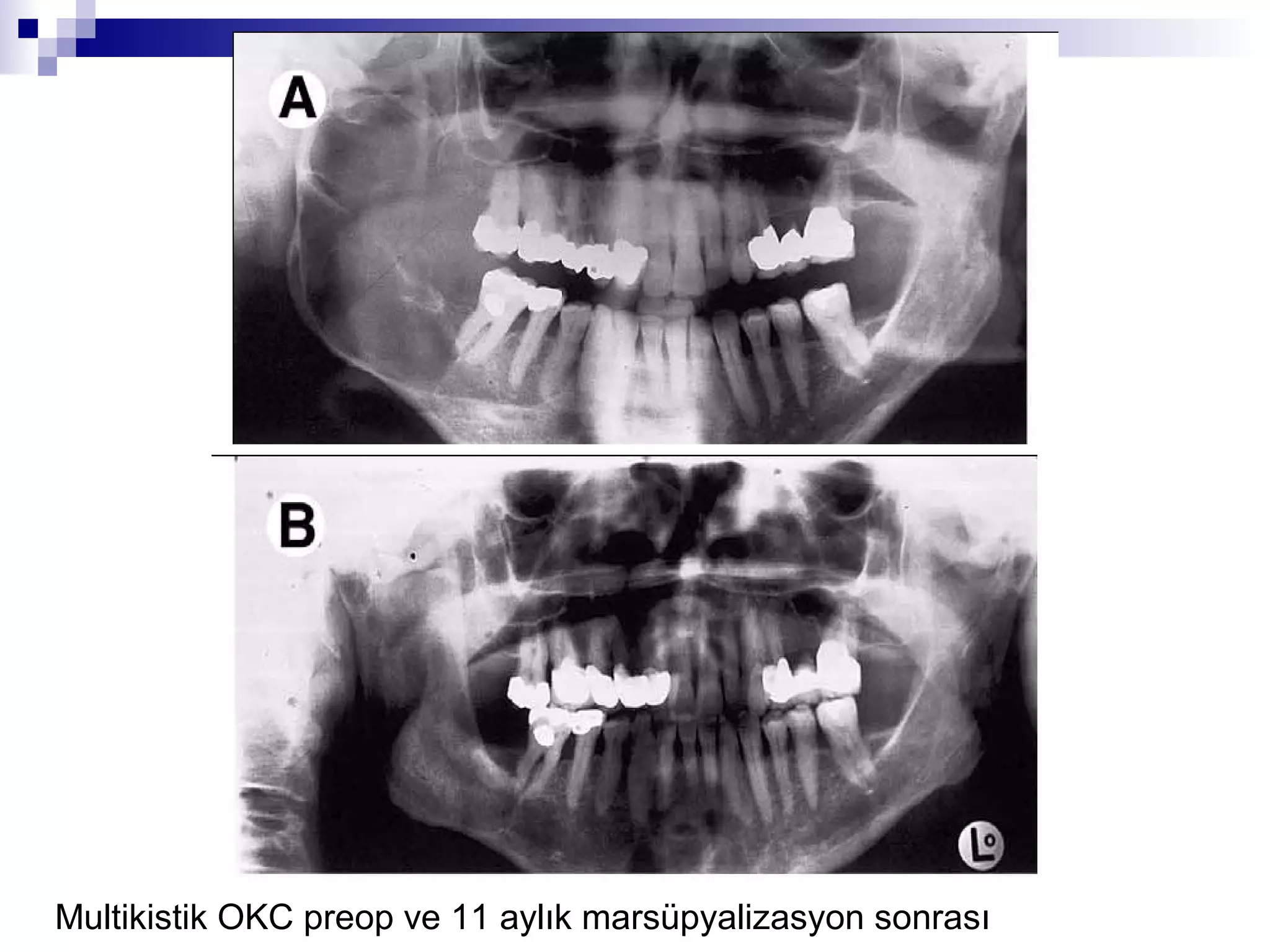 Odontojenik Keratokist (Keratokistik Odontojenik Tümör) | PPT