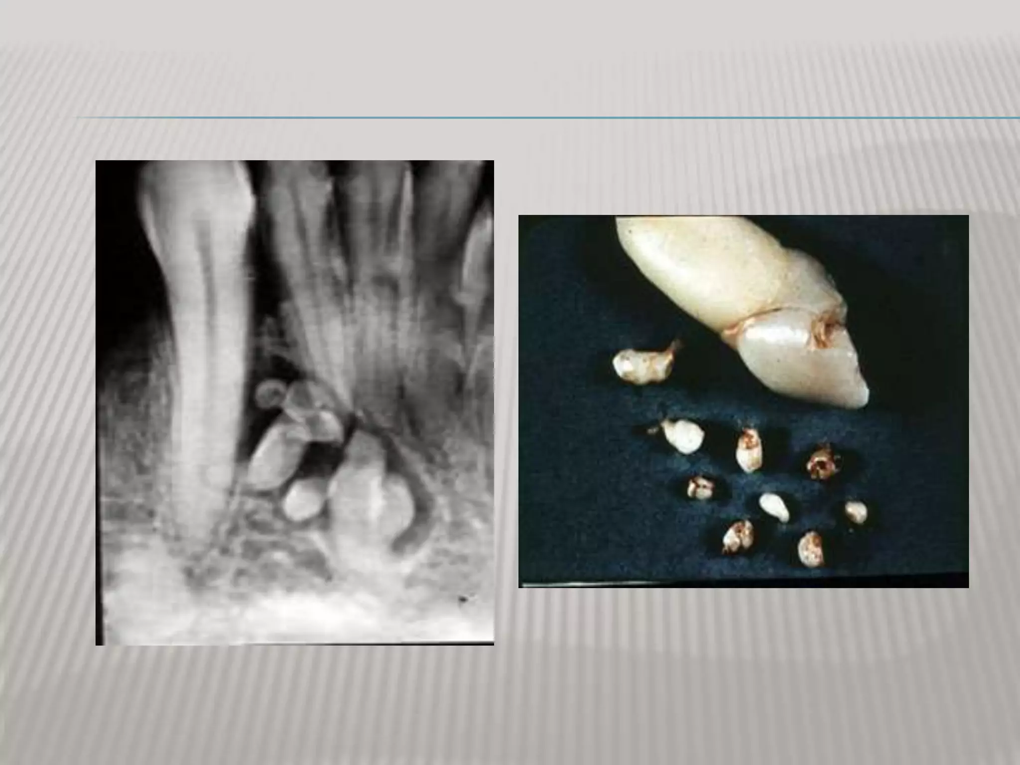 Odontoma (Doctor Faris Alabeedi MSc, MMedSc, PgDip, BDS.) | PPTX