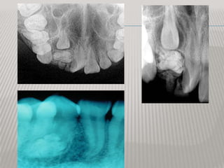 Odontoma (Doctor Faris Alabeedi MSc, MMedSc, PgDip, BDS.) | PPTX