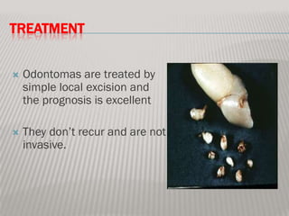 Odontoma (Doctor Faris Alabeedi MSc, MMedSc, PgDip, BDS.) | PPTX