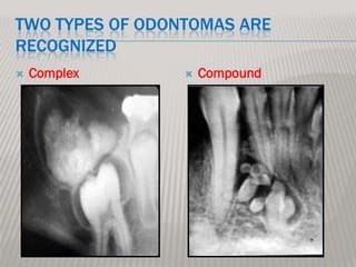 Odontoma (Doctor Faris Alabeedi MSc, MMedSc, PgDip, BDS.) | PPTX
