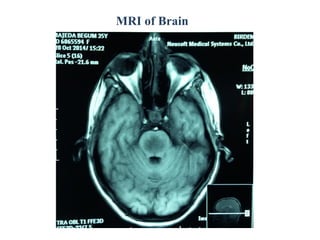 Osmotic Demyelination Syndrome | PPT