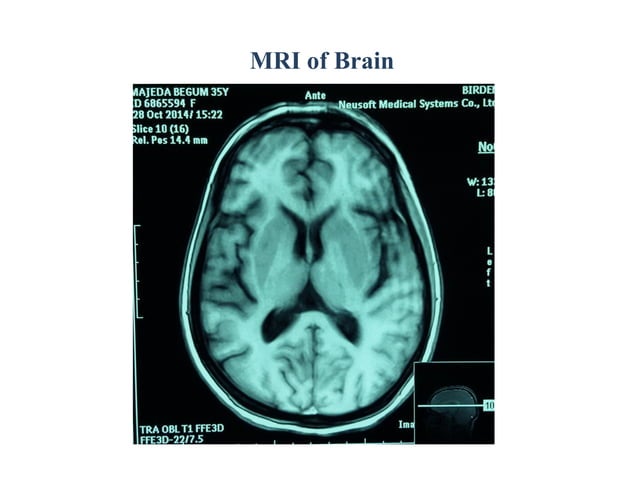 Osmotic Demyelination Syndrome | PPT | Brain and Nervous System ...