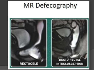 Obstructive defecation syndrome | PPTX