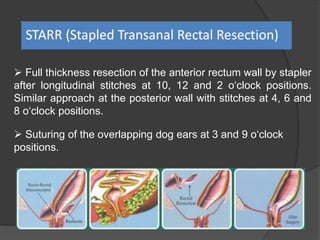 Obstructive defecation syndrome | PPTX