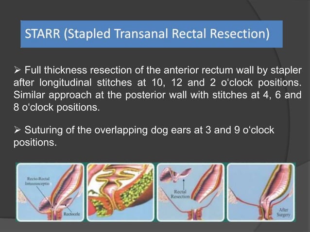 Obstructive defecation syndrome