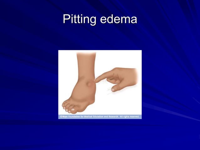 Oedema_edema_Dr_saravjit_singh_pathology.ppt