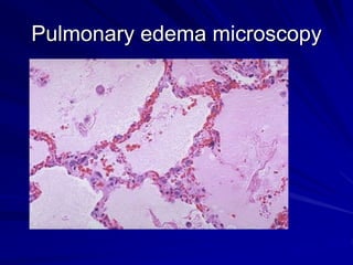 Oedema_edema_Dr_saravjit_singh_pathology.ppt