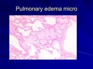 Oedema_edema_Dr_saravjit_singh_pathology.ppt