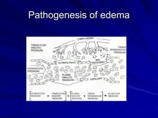 Oedema_edema_Dr_saravjit_singh_pathology.ppt