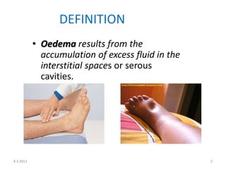 Oedema 2 | PPT
