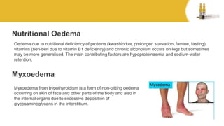 Edema | PPTX