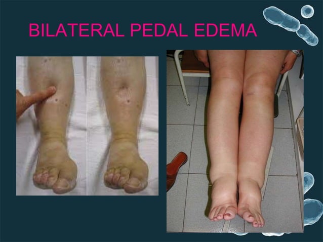 OEDEMA PATHOLOGY (1).pptx