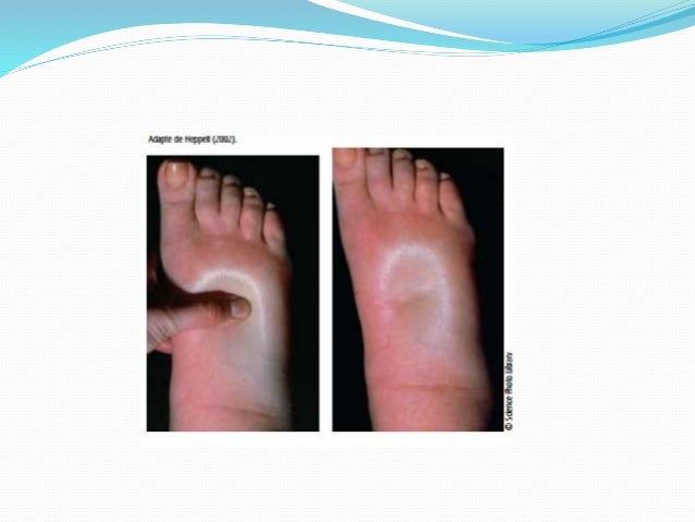 Oedemes, cours pour paramédicaux