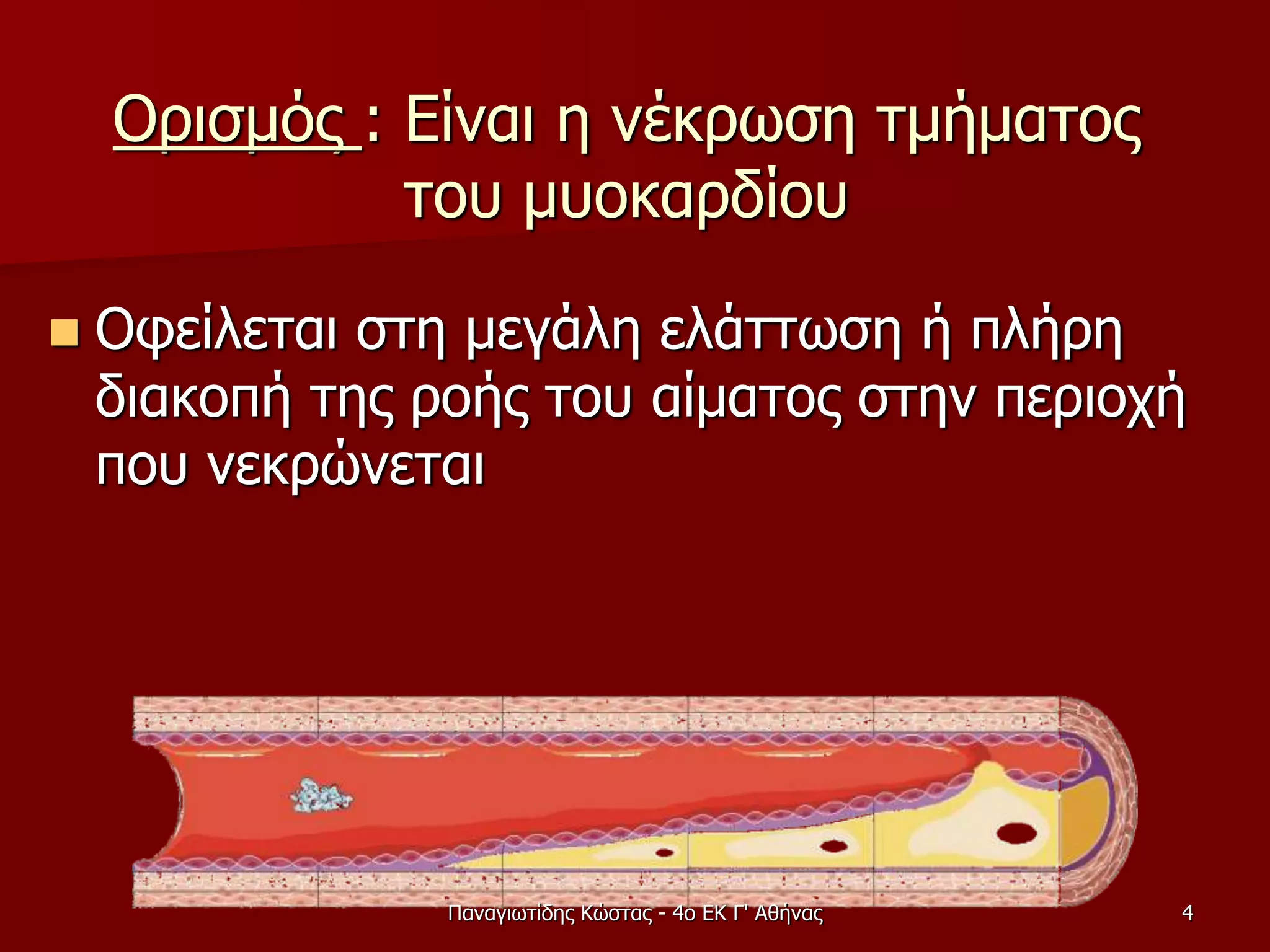 ΟΞΥ ΚΑΡΔΙΑΚΟ ΝΟΣΗΜΑ: ΤΟ ΟΞΥ ΕΜΦΡΑΓΜΑ ΤΟΥ ΜΥΟΚΑΡΔΙΟΥ | PPTX