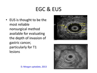 Early Detection and Management of Oesophageal and Gastric Tumours | PPT