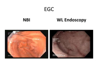 Early Detection and Management of Oesophageal and Gastric Tumours | PPT