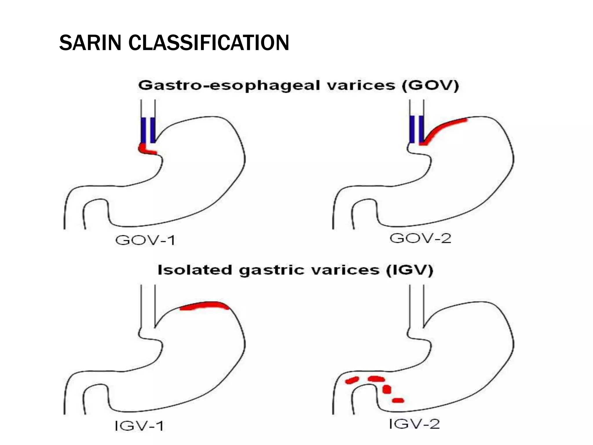 Oesophageal and gastric varices classifications | PPTX