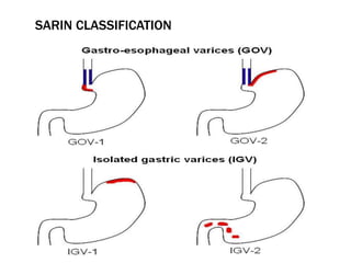 Oesophageal and gastric varices classifications | PPT