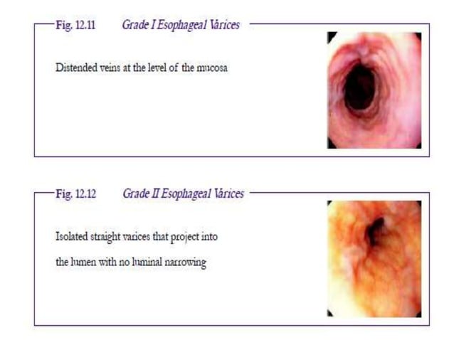 Oesophageal and gastric varices classifications | PPTX