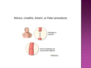 Oesophageal atresia | PPTX