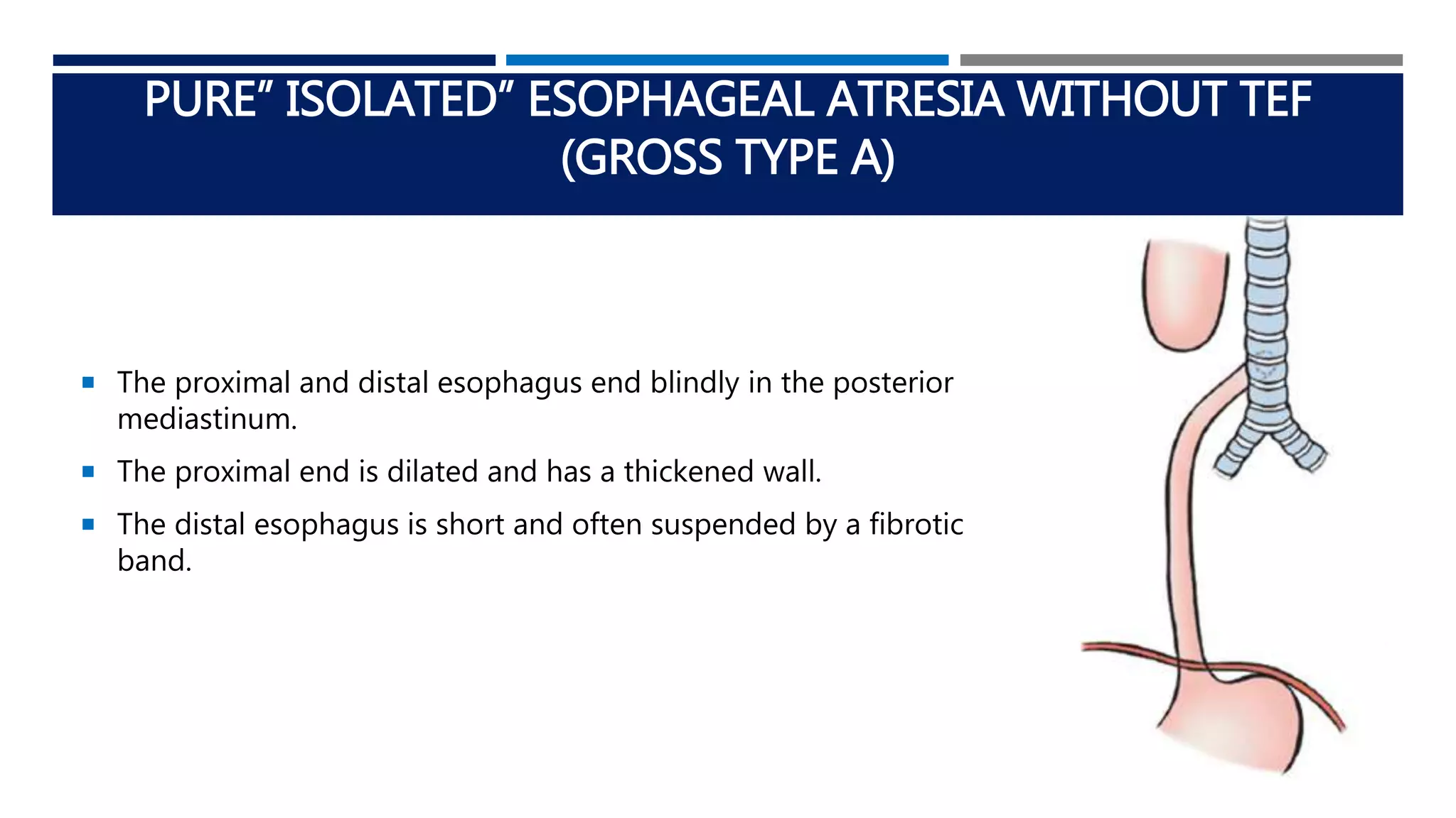 esophageal atresia | PPTX