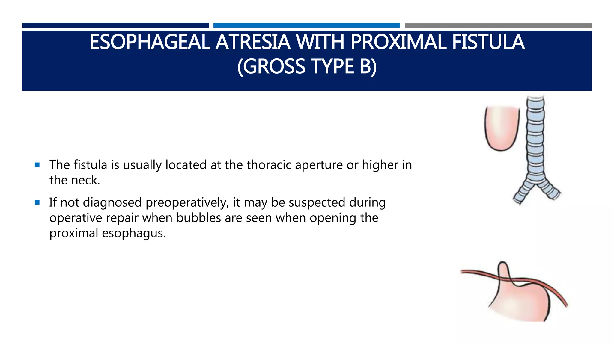esophageal atresia | PPTX