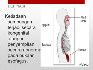 OESOPHAGEAL ATRESIA | PPT