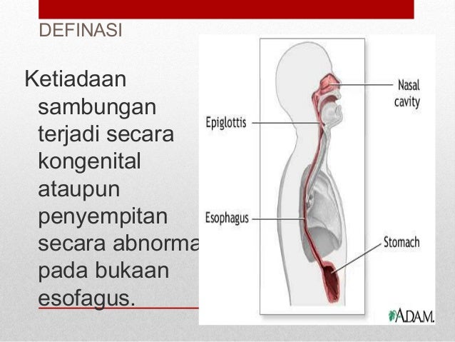 OESOPHAGEAL ATRESIA