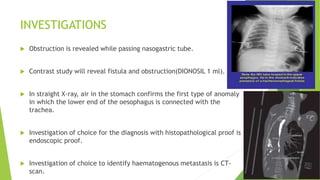 Oesophageal atresia | PPTX