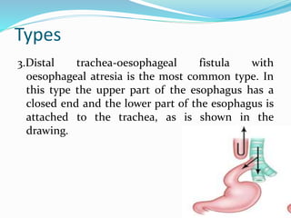 Oesophageal atresia.pptx