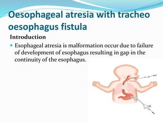Oesophageal atresia.pptx