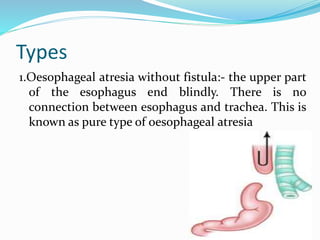 Oesophageal atresia.pptx