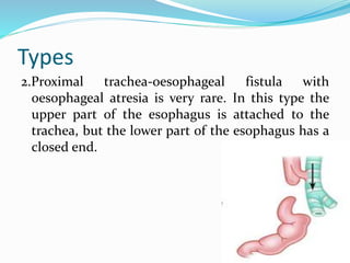 Oesophageal atresia.pptx