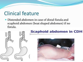 Scaphoid Shaped Abdomen