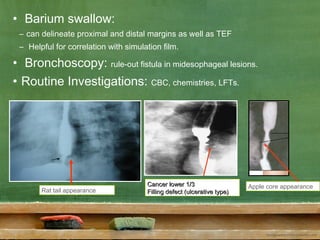 Oesophageal carcinoma | PPT