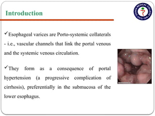 Oesophageal varices.pptx Chronic liver disease. | PPTX