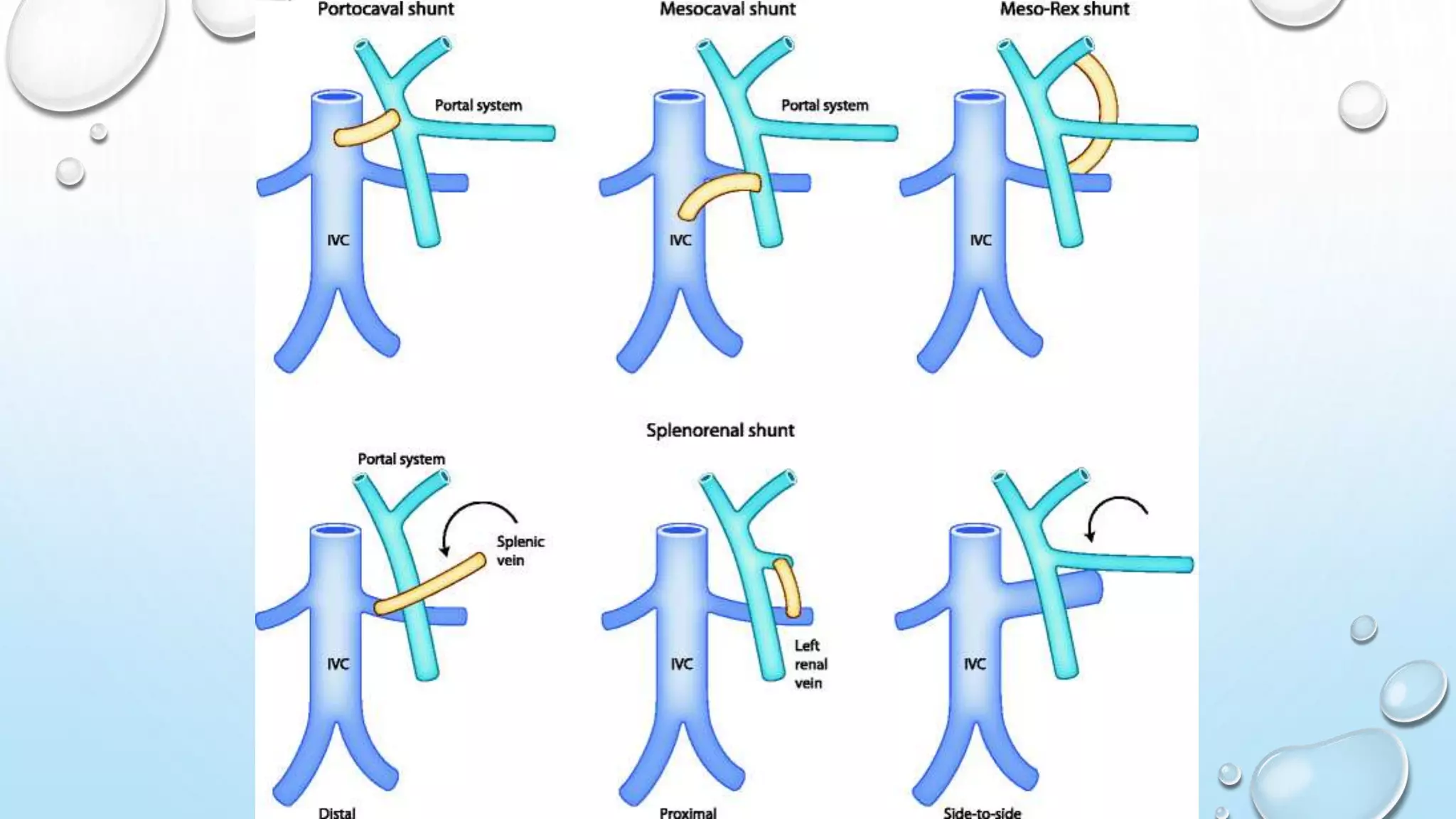Oesophageal varices ppt slideshare | PPTX