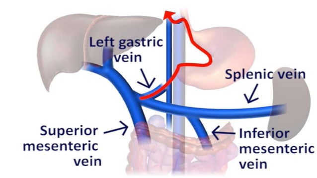 Oesophageal Varices Ppt Slideshare Ppt