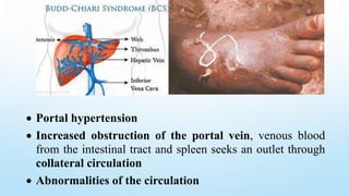 Oesophageal varices ppt slideshare | PPTX